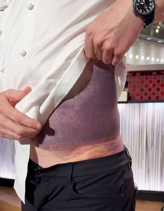 ‘I Am in Pain’: What Happened to Gordon Ramsay?