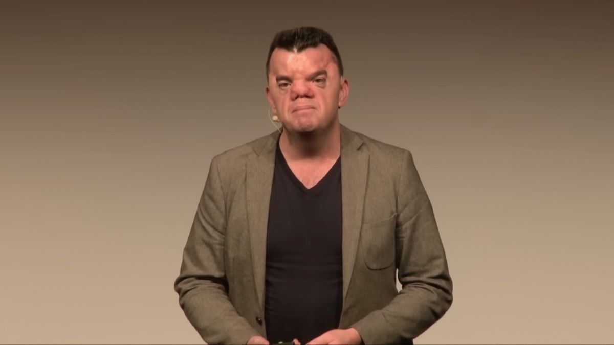 What happened to Robert Hoge's face? – We Got This Covered